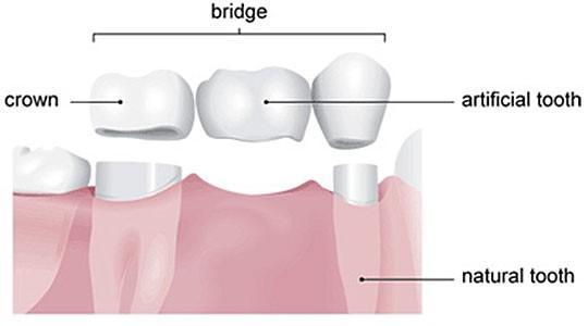 bridges - Moncton Smiles